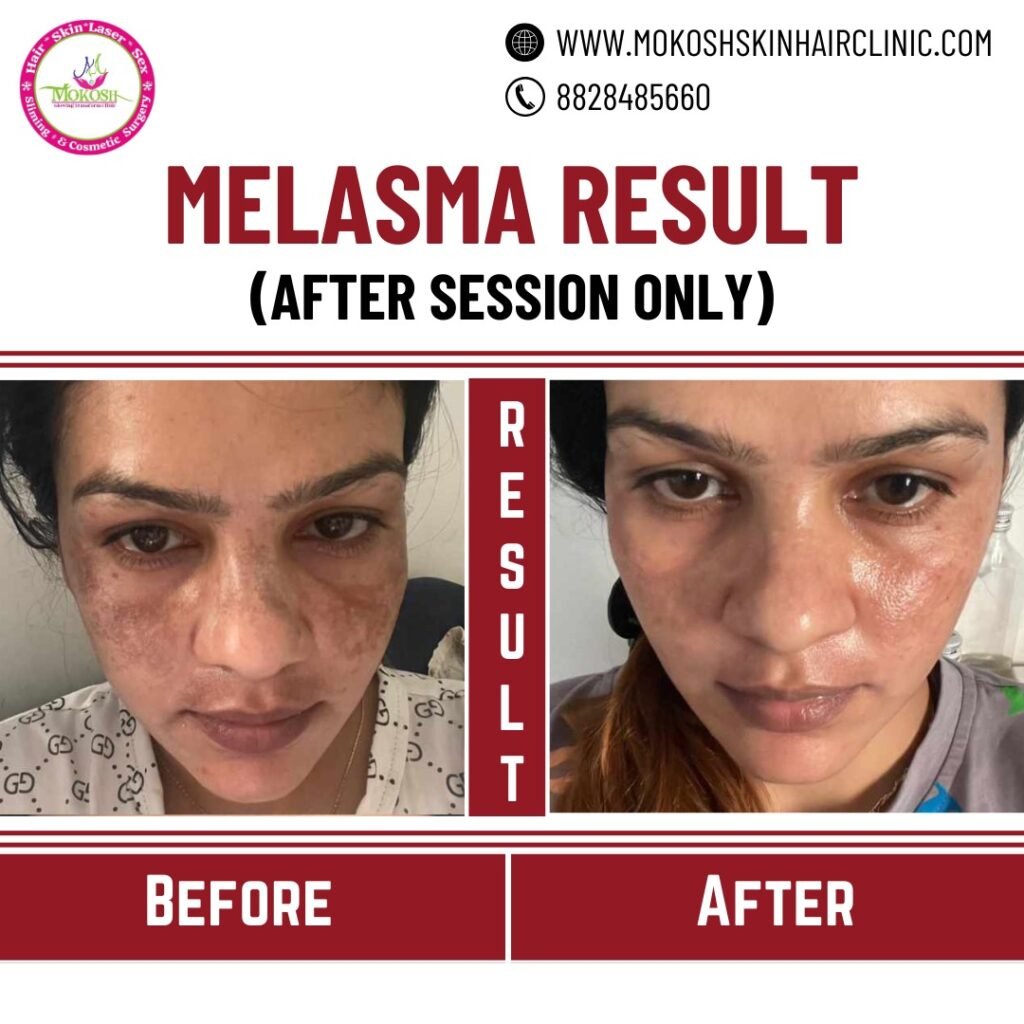 Melasma Treatment - ewadermaclinic.com